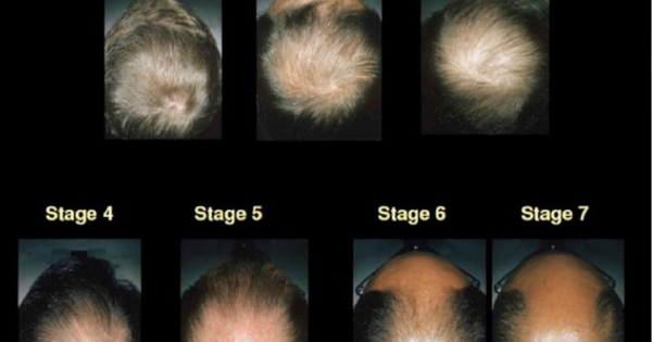 Platelet Rich Plasma (PRP), an effective treatment for hair loss