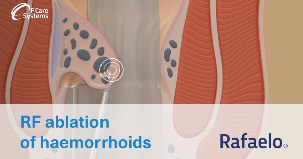 Rafaelo procedure